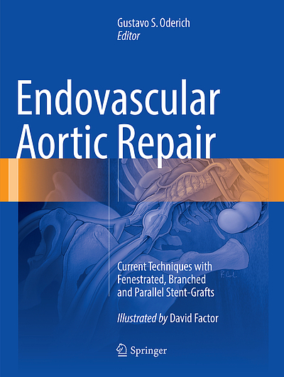 Endovascular aortic repair : current techniques with fenestrated ...